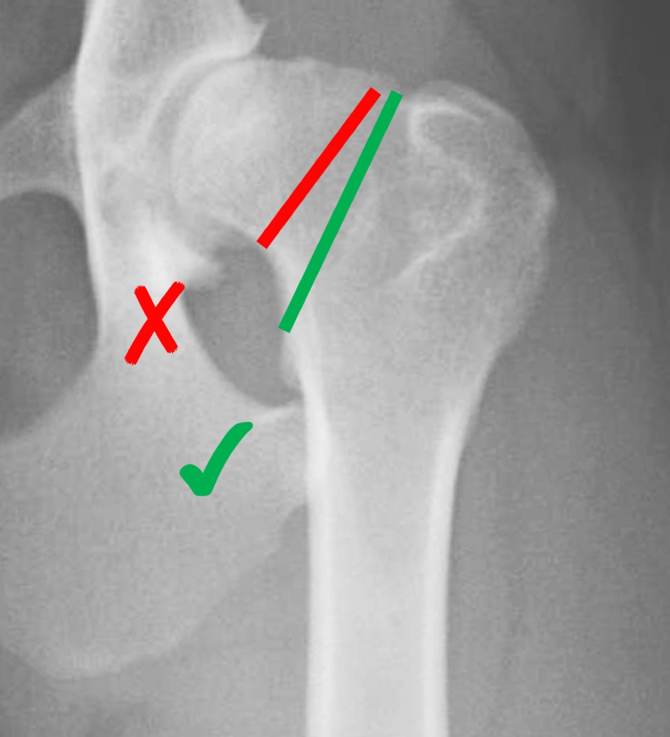 Hip dysplasia - when do we consider surgery?
